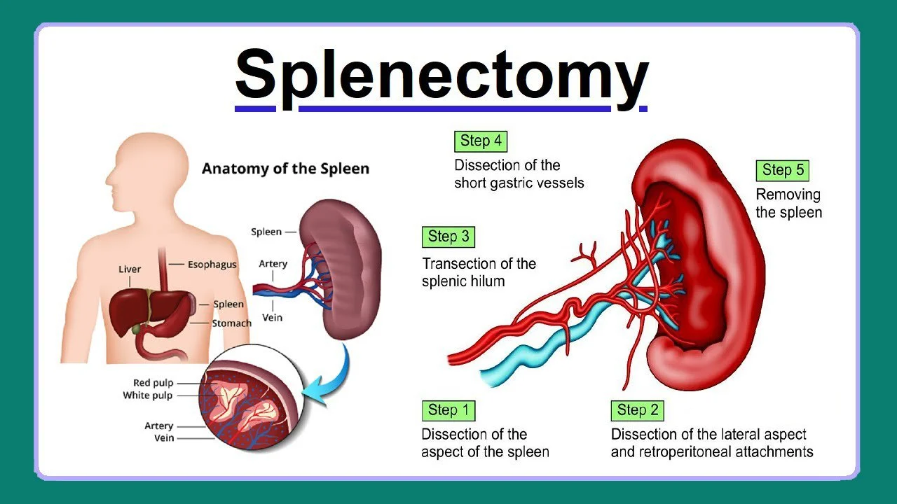 Appendectomy Liberty Clinic Appendectomy Liberty Clinic