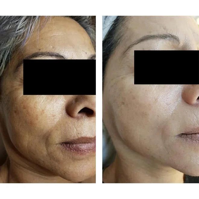 Witness Stunning Transformations: Before and After Results — Skintech Spa