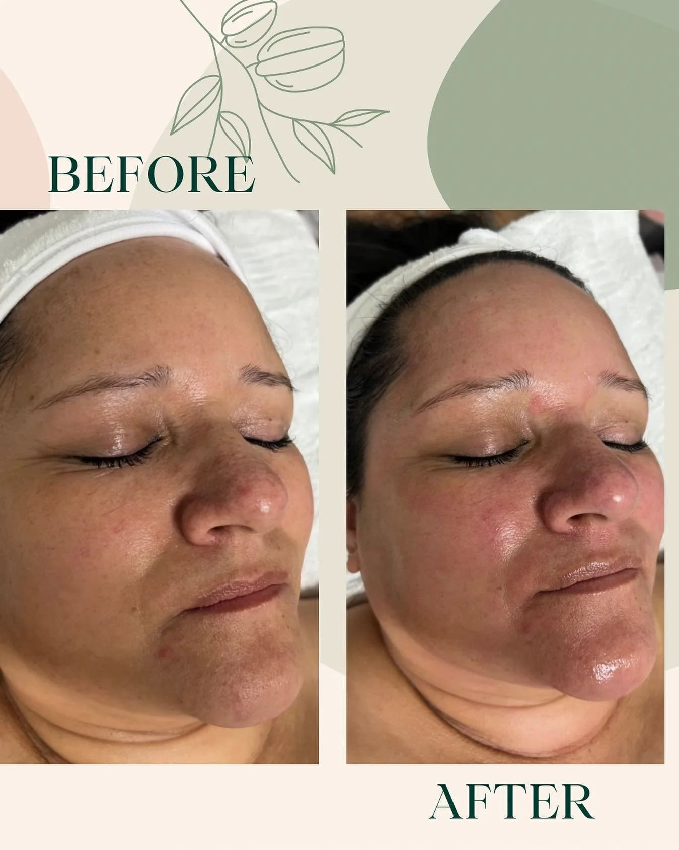 Bellalaser - Laser Hair Removal and Skincare