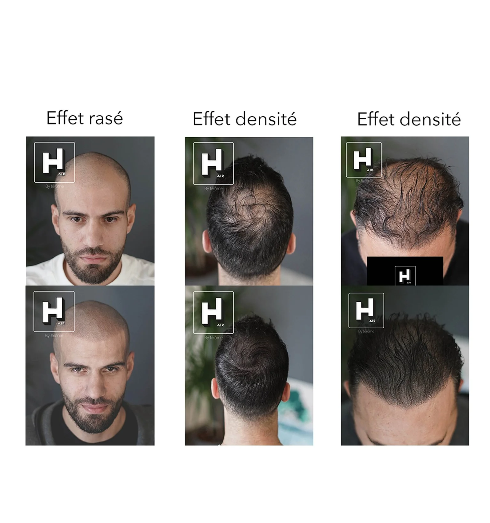 Solution à la calvitie par dermopigmentation entre Namur et Liège