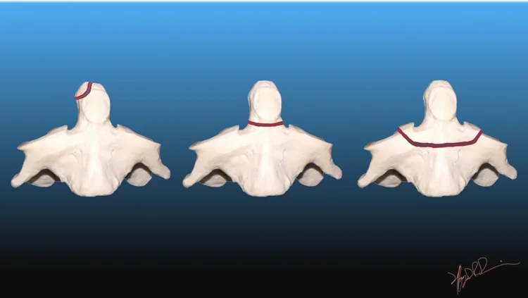 Spine Trauma (OccipitoCervical) — Neuro-Bullets