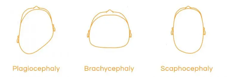 Brachycephaly, scaphocephaly, plagiocephaly, oh my! — Year One Wellness ...