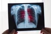 Abnormal Chest X-Ray After an IME: What It Can Mean Next