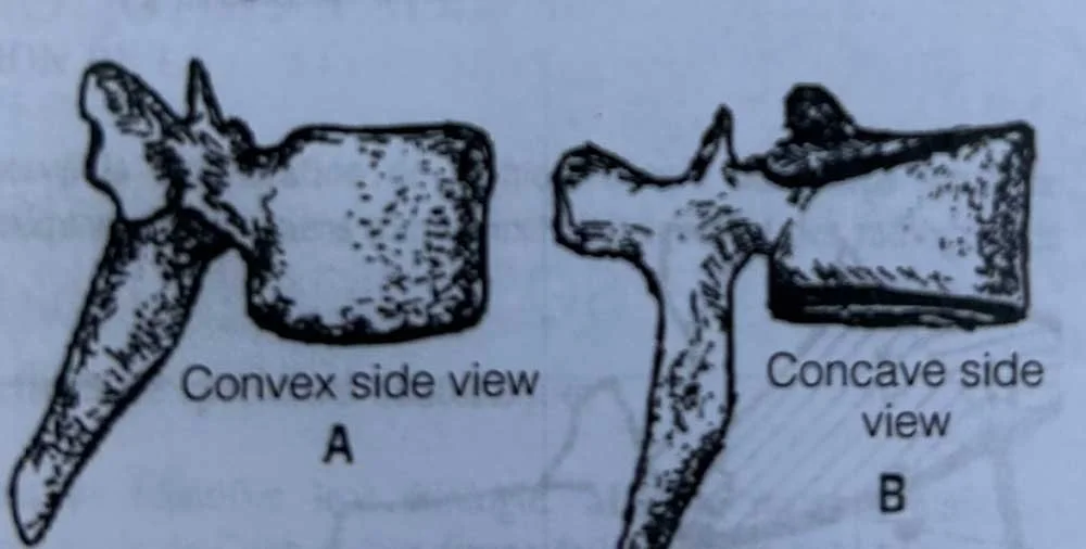 What is Adolescent Idiopathic Scoliosis? | Schroth DC