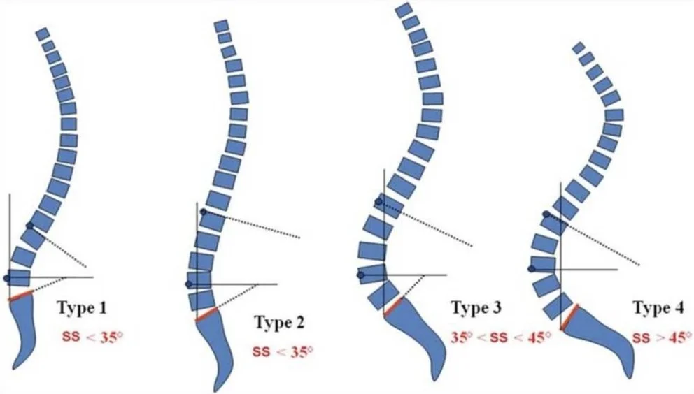 What Spine Type are You? | Schroth DC