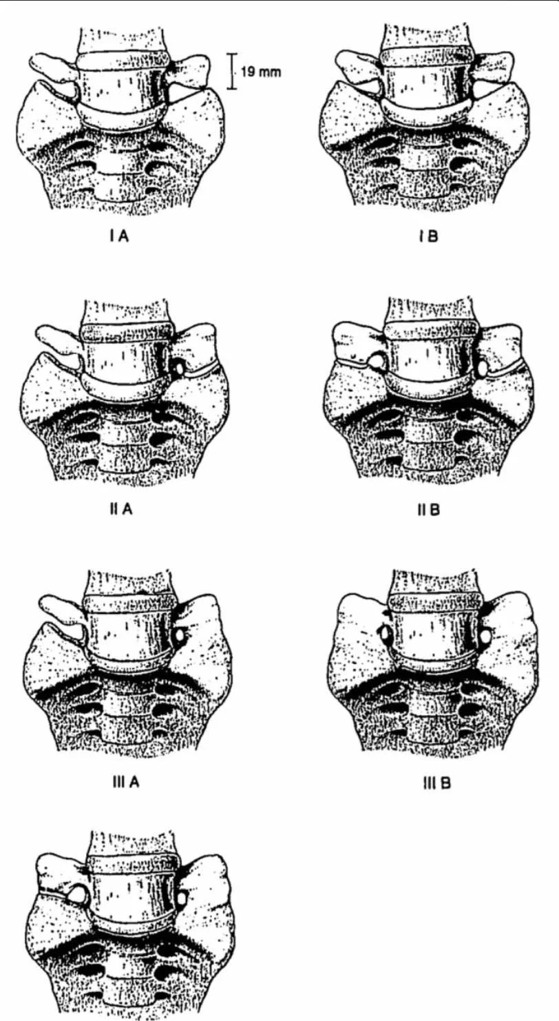 Bertolotti Syndrome and Scoliosis | Schroth DC