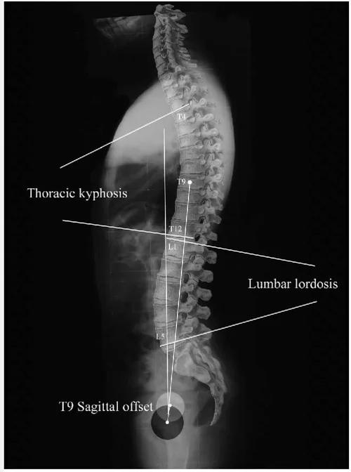 Treating Adult Scoliosis with the Schroth Method | Schroth DC