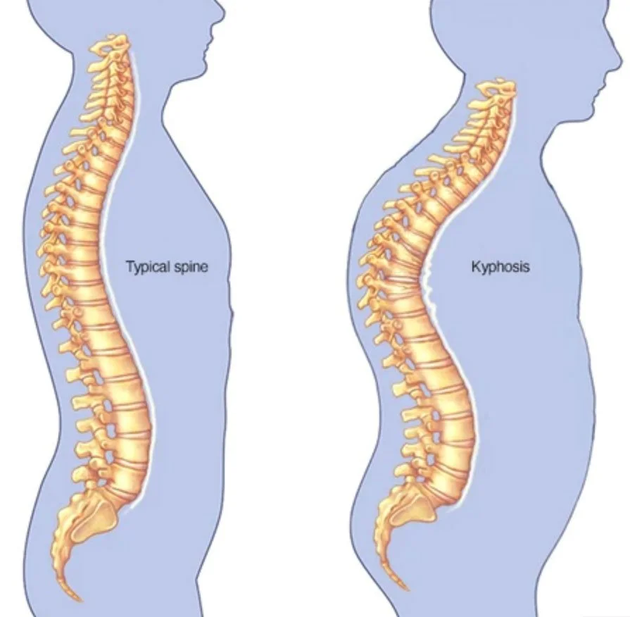 Schroth Method for Kyphosis | Schroth DC