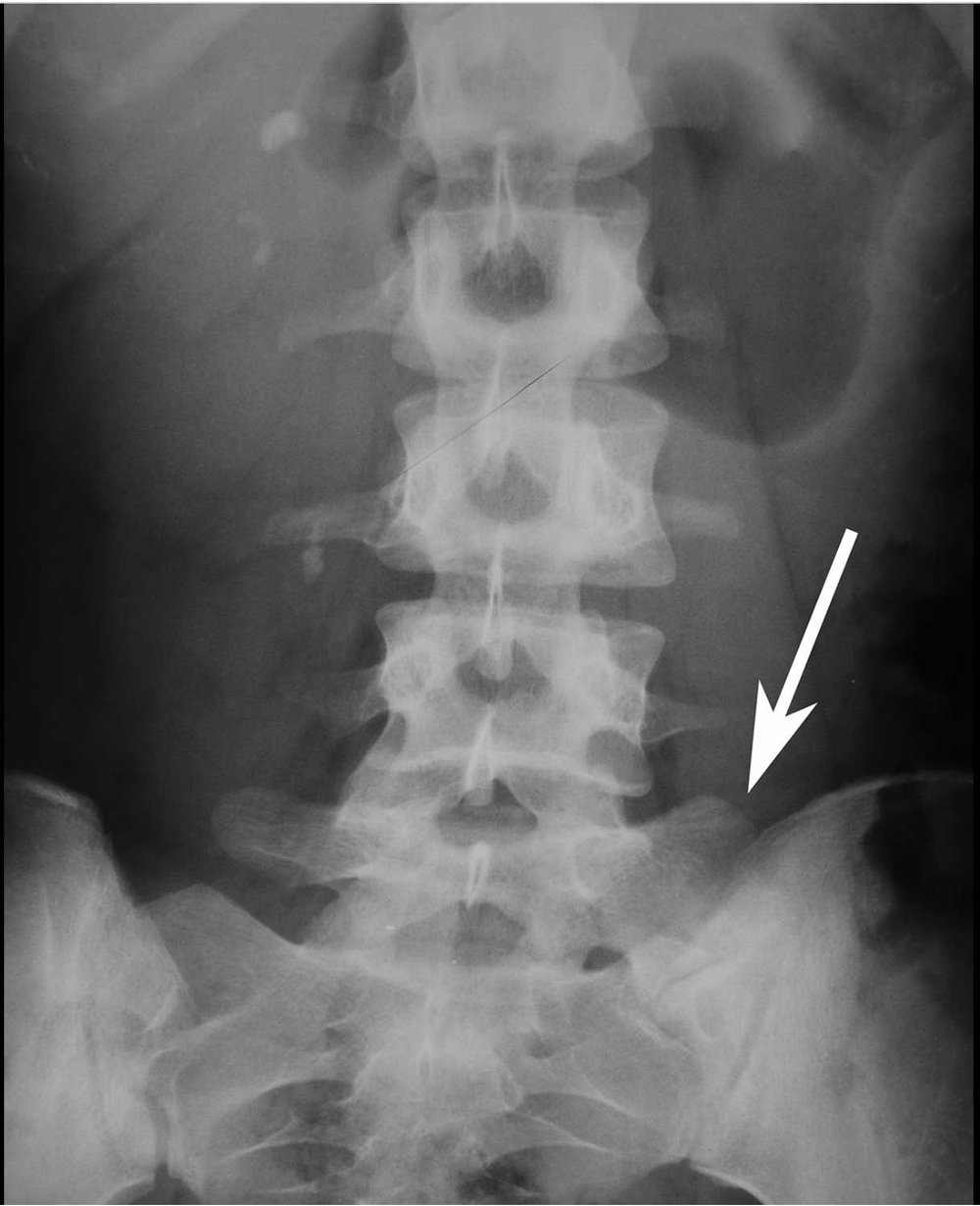 Bertolotti Syndrome and Scoliosis | Schroth DC