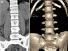 Bertolotti Syndrome and Scoliosis | Schroth DC