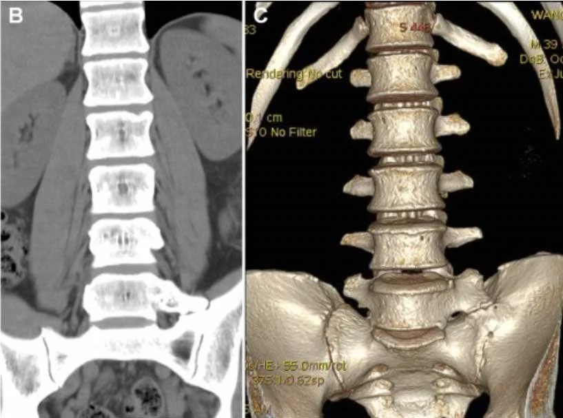 Bertolotti Syndrome and Scoliosis | Schroth DC