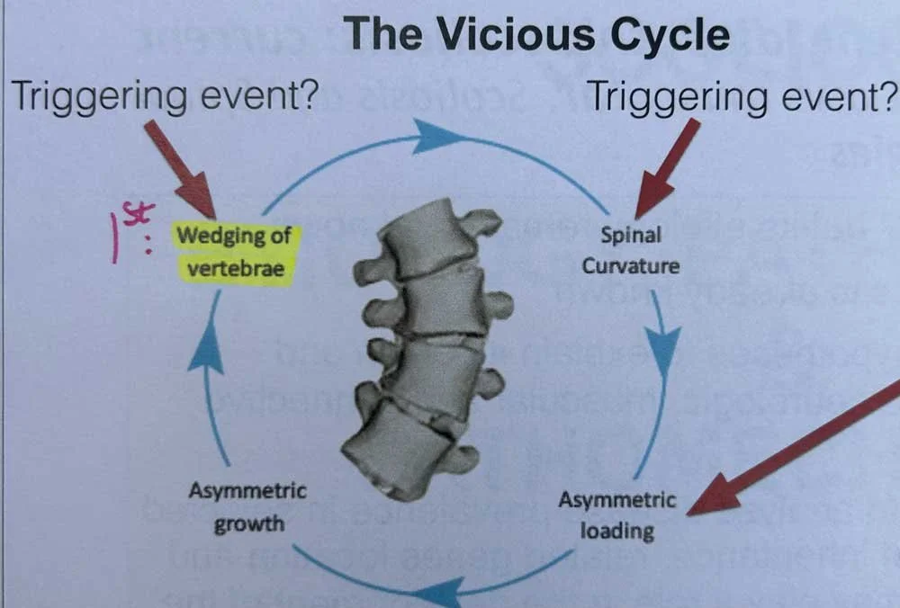 What is Adolescent Idiopathic Scoliosis? | Schroth DC
