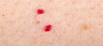 Cherry Angiomas: Causes & Treatments | Beautilase