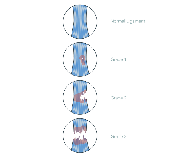 Your complete Guide to ACL sprains: diagnosis, treatment and recovery ...