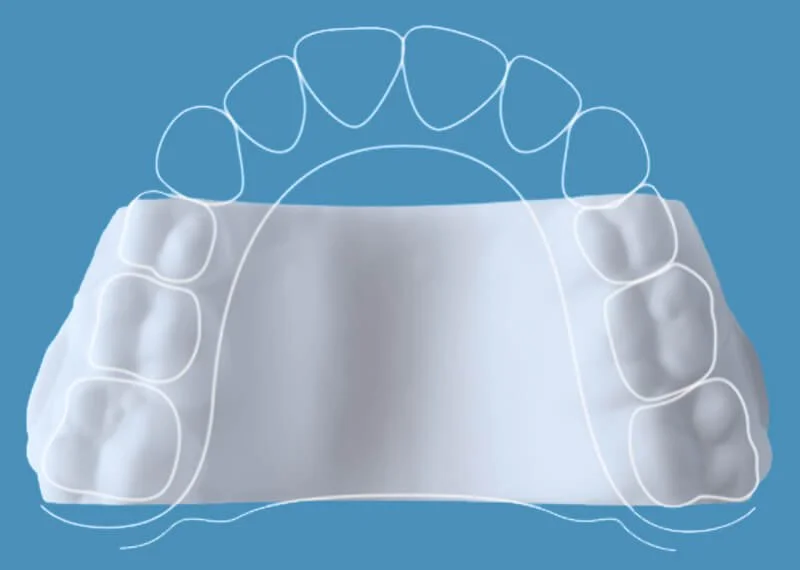 Revolutionizing Early Orthodontics: The Invisalign® Palatal Expander System for Kids — Grace ...