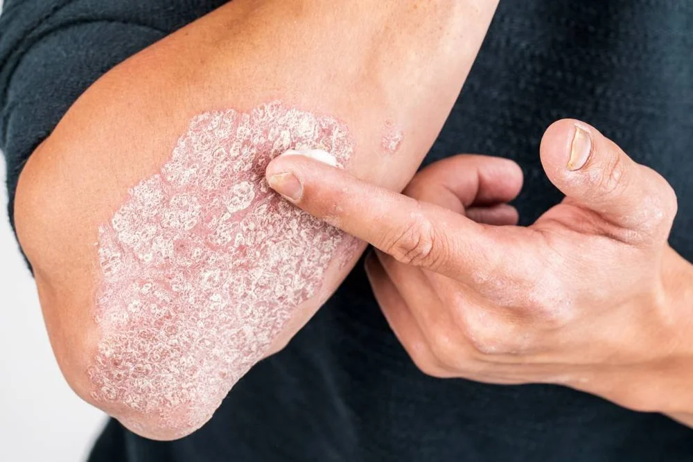 PSORIASIS TREATMENT IN SUGARLAND, TEXAS — Sweetwater Dermatology