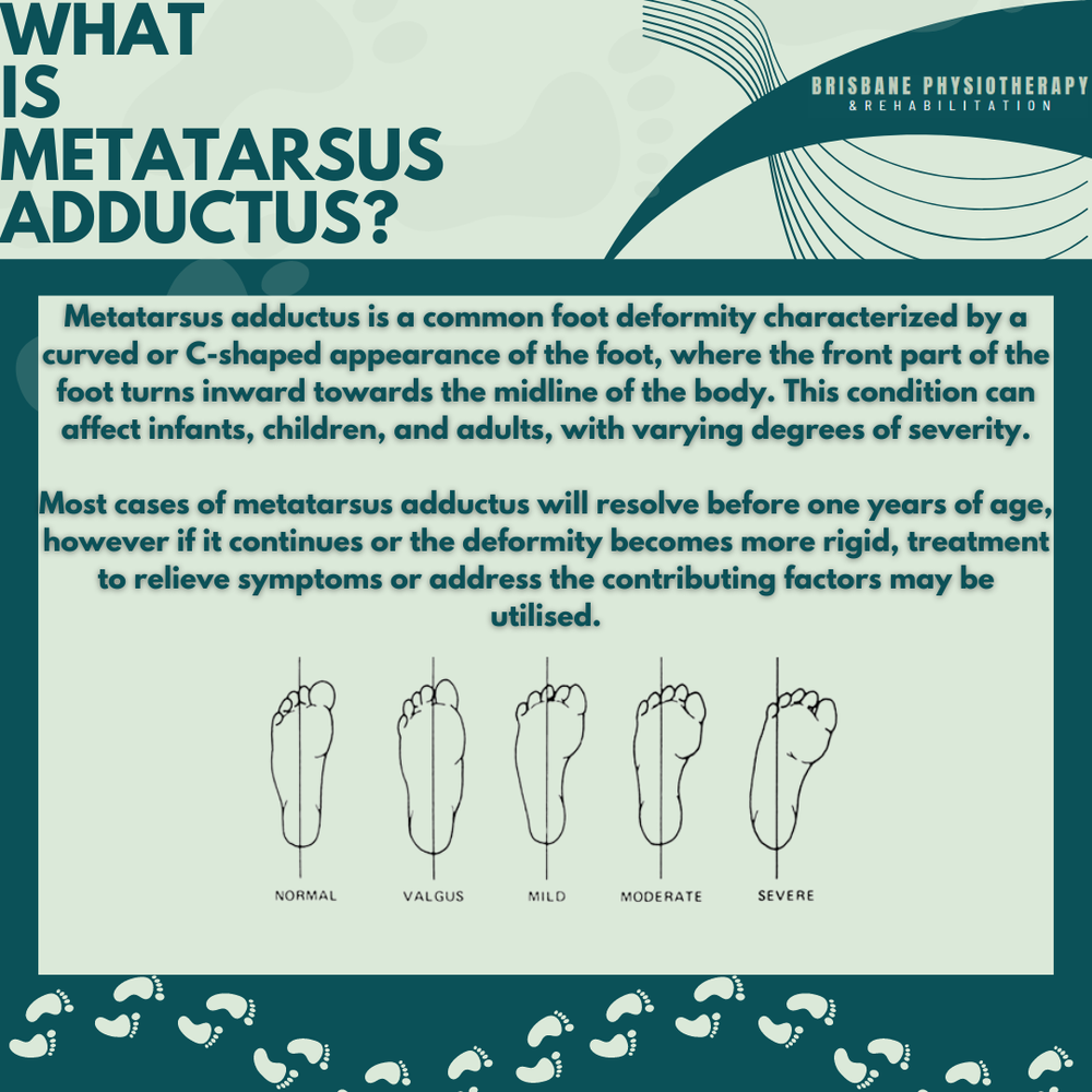 What is Metatarsus Adductus? - Brisbane Physiotherapy & Podiatry