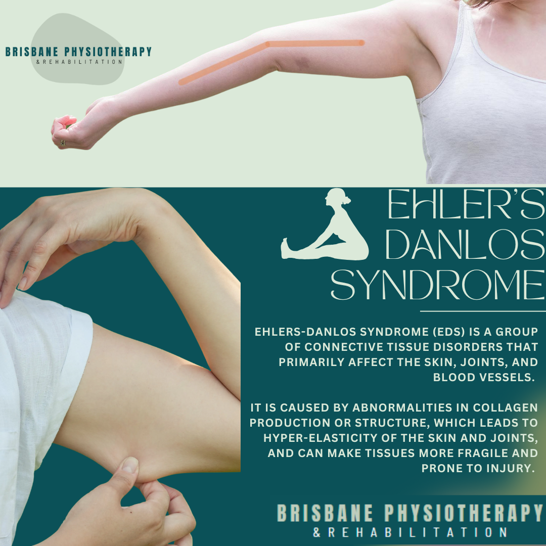 What Is Eds Ehlers Danlos Syndrome What Is Eds Ehlers Danlos Syndrome