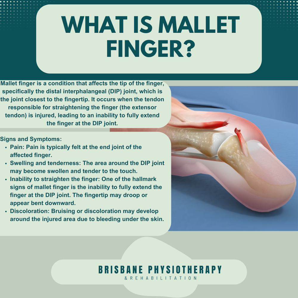 What is Mallet Finger? - Brisbane Physiotherapy & Podiatry