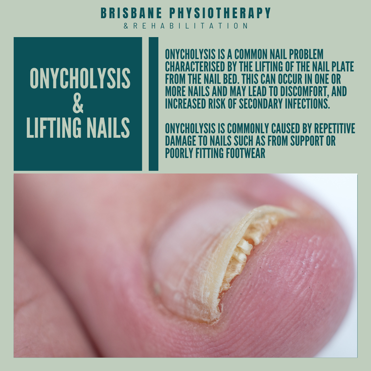 What is Onycholysis or Lifting Nail? - Brisbane Physiotherapy & Podiatry