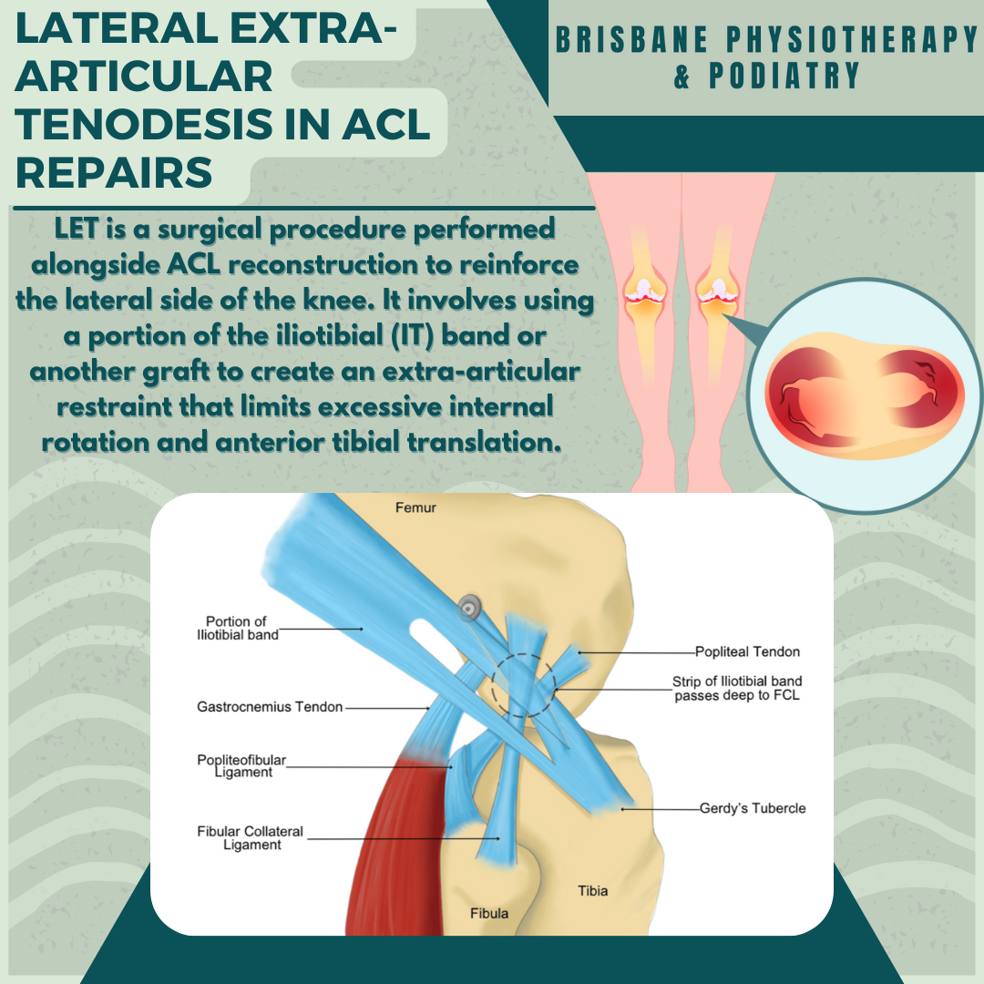 Physiotherapy Guide: Lateral Extra-Articular Tenodesis in ACL Repairs ...