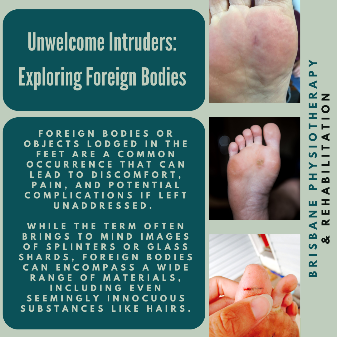 Unwelcome Intruders: Exploring Foreign Bodies in the Feet - Brisbane ...