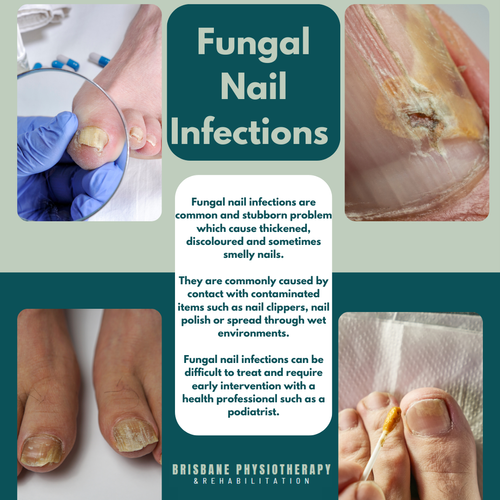 Fungal Nail Infection / Onychomycosis - Causes, Symptoms & Podiatry ...