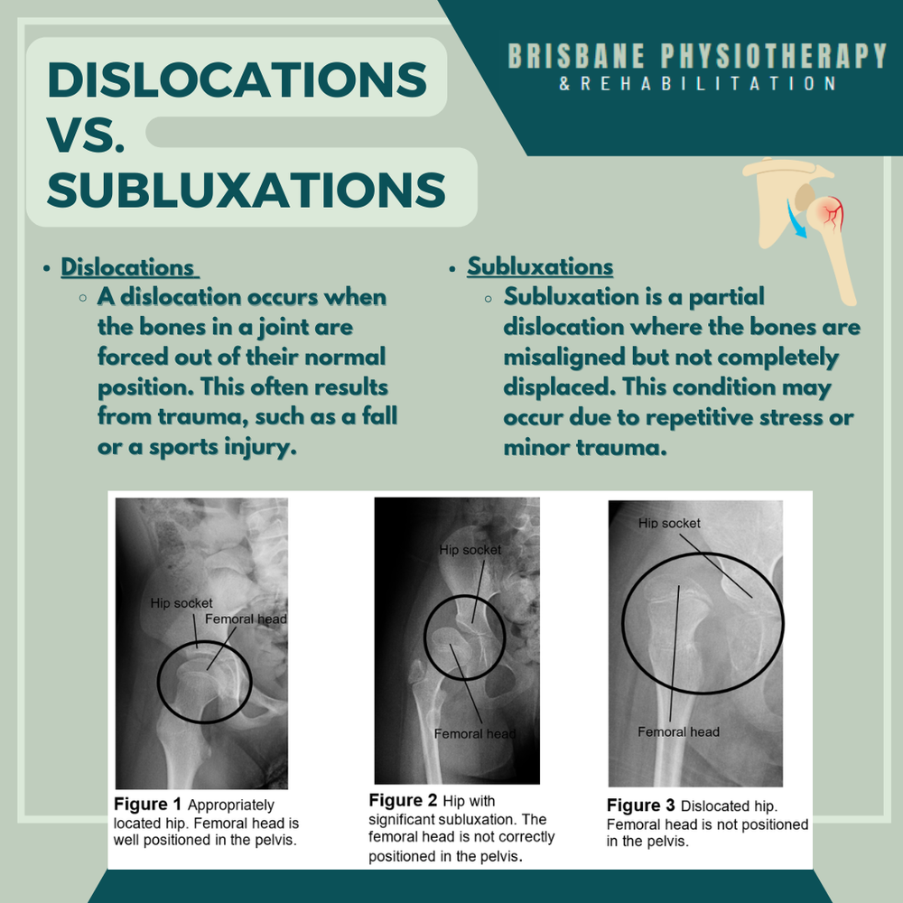 Dislocations vs. Subluxations - Brisbane Physiotherapy & Podiatry