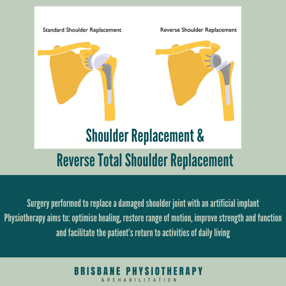 Shoulder Replacement - Physio Rehab including Reverse Total Shoulder ...