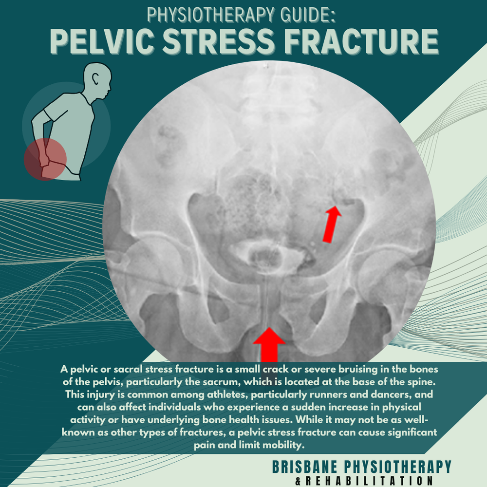Pelvic stress fractures - Brisbane Physiotherapy & Podiatry