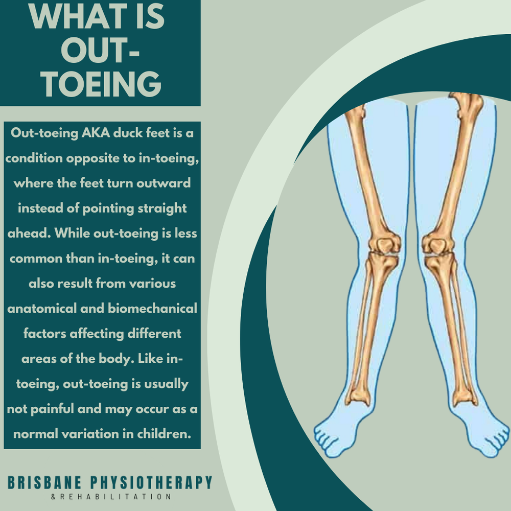 What is Out-Toeing? - Brisbane Physiotherapy & Podiatry