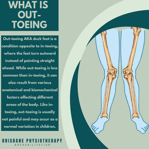 What is Out-Toeing? - Brisbane Physiotherapy & Podiatry
