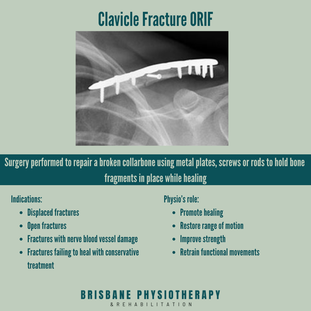 Clavicle Fractures - Treatment, Recovery & ORIF - Brisbane ...