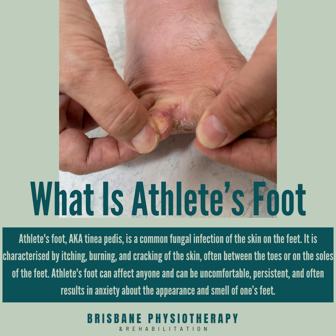 What Is Athlete’s Foot? - Brisbane Physiotherapy & Podiatry