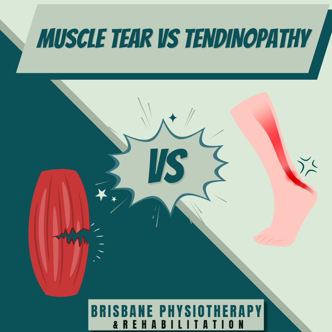 Muscle Tears vs Tendinopathy - Difference Between Tendinopathy & Muscle ...