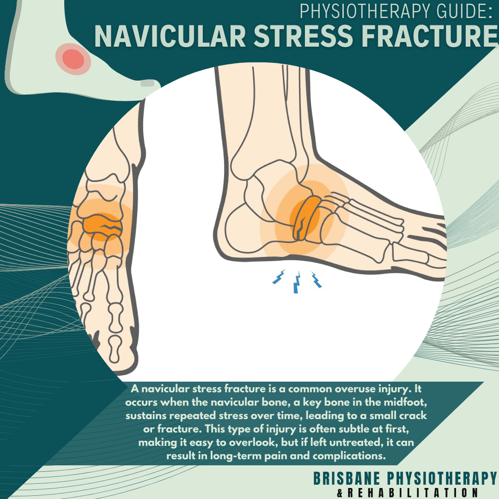 Navicular Stress Fractures and How Your Physiotherapist Can Help ...