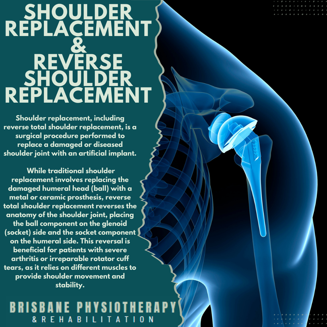 Shoulder Replacement - Physio Rehab including Reverse Total Shoulder ...