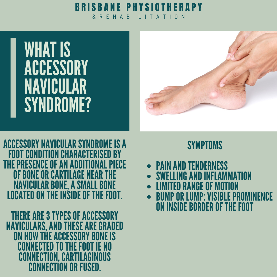 What Is Accessory Navicular Syndrome? - Brisbane Physiotherapy & Podiatry
