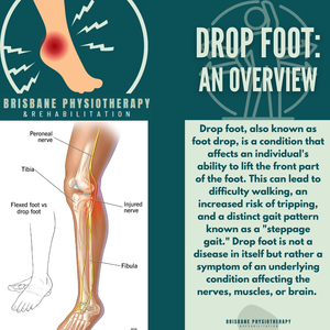 Understanding Drop Foot and How Physiotherapy Can Help - Brisbane ...