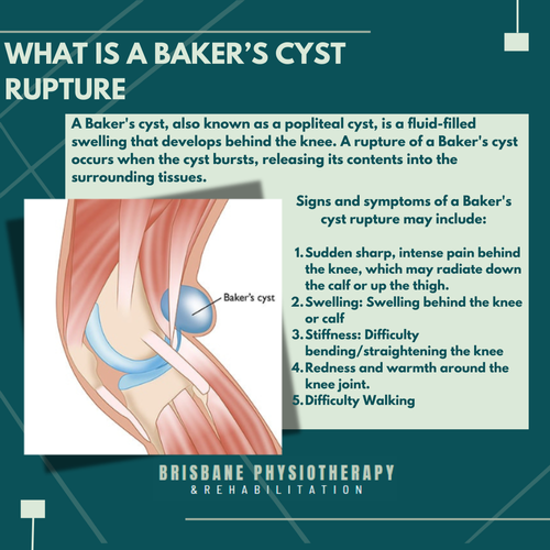 Baker's Cyst - What is a Baker Knee Cyst - Symptoms & Treatment ...