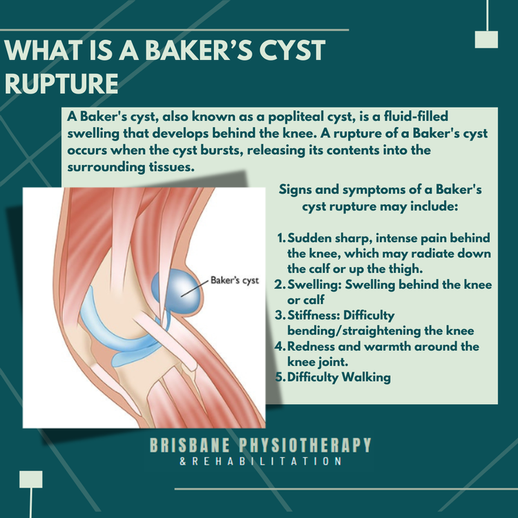 Baker's Cyst - What is a Baker Knee Cyst - Symptoms & Treatment ...