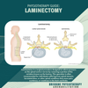 Laminectomy: Understanding the Procedure and the Role of Physiotherapy ...