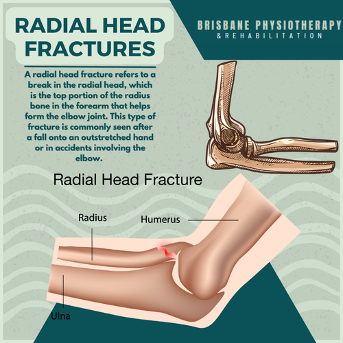 Understanding Radial Head Fractures and how Physiotherapy can help ...