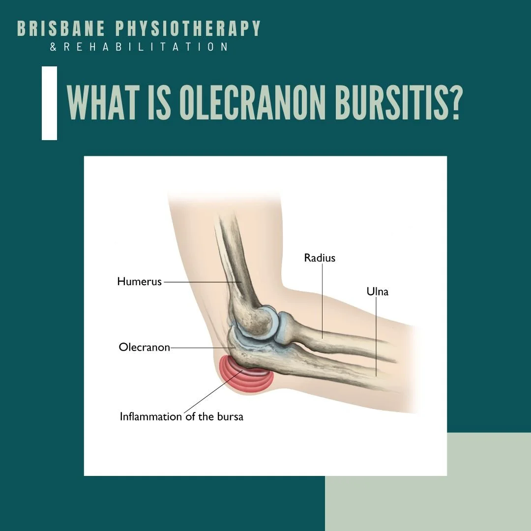 Olecranon Bursitis - What is it and how to treat it - Brisbane ...