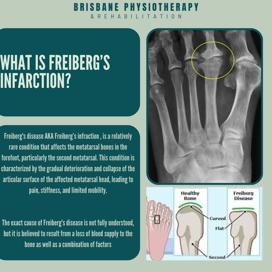 Freiberg's Disease - Freiberg Infraction - Symptoms, Treatment ...