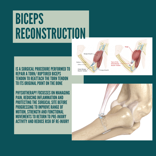 Biceps Reconstruction - Brisbane Physiotherapy & Podiatry