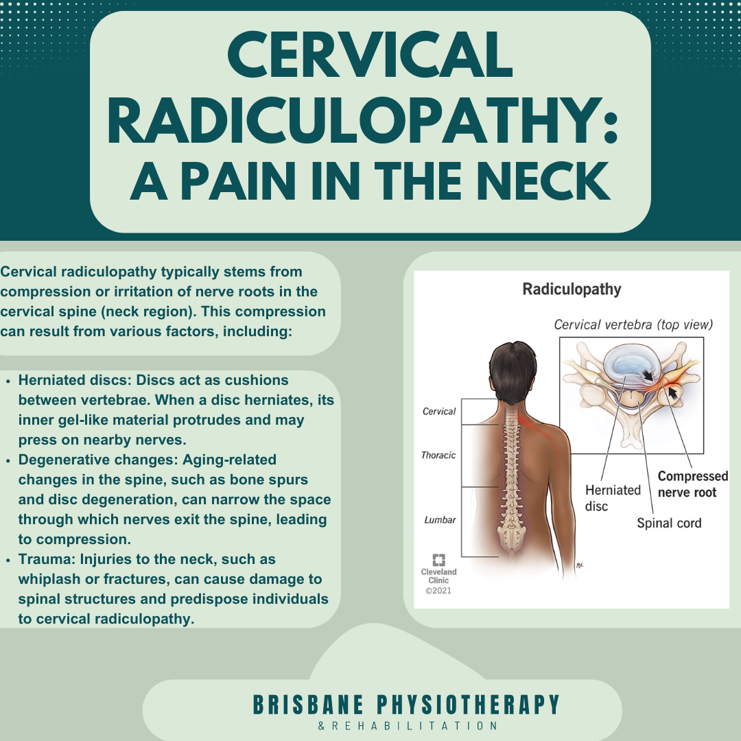 What is Cervical Radiculopathy? - Brisbane Physiotherapy & Podiatry