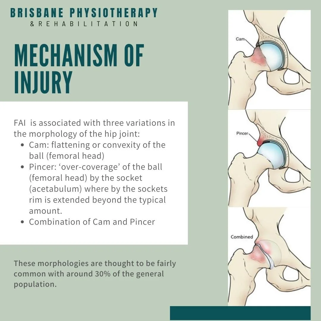 FAI Syndrome - FAI Hip Impingement Syndrome - Symptoms, Diagnosis ...