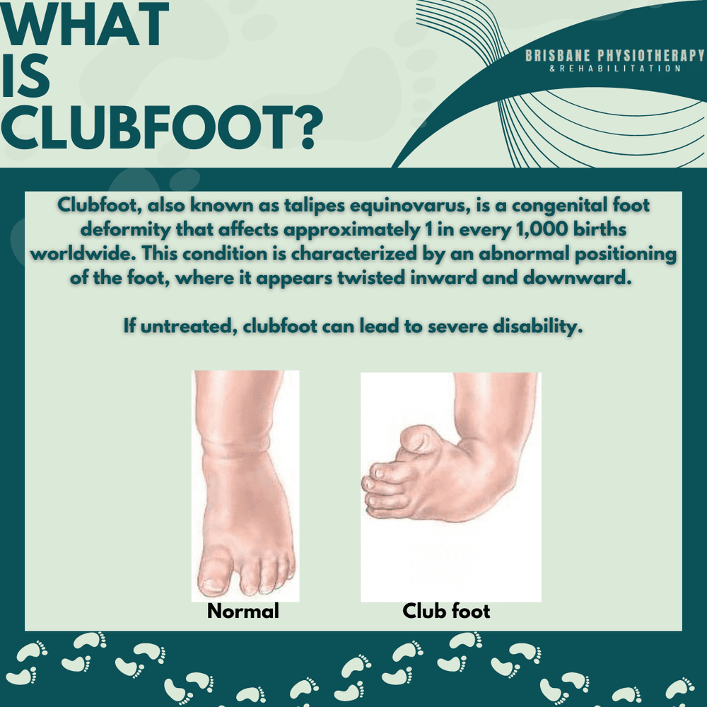 What is Clubfoot (Talipes Equinovarus)? - Brisbane Physiotherapy & Podiatry