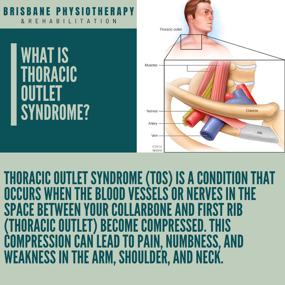 What is Thoracic Outlet Syndrome? - Brisbane Physiotherapy & Podiatry